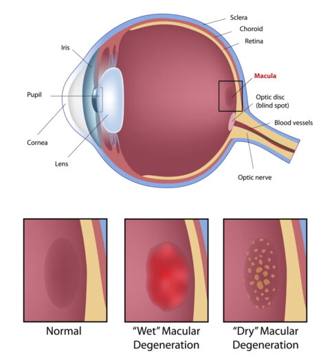 Macular Degeneration Treatment, Poughkeepsie & Red Hook - Dutchess ...